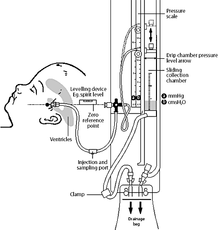 Forward: EVD(Extra Ventricular Drainage