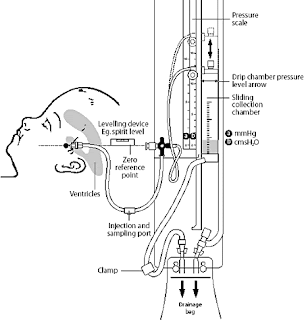 Forward: EVD(Extra Ventricular Drainage