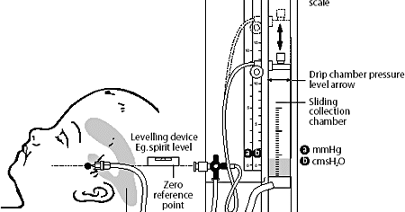 Forward: EVD(Extra Ventricular Drainage