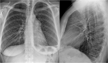 Chest Medicine Made Easy-Dr Deepu: BASICS OF CHEST X RAY-PART 5, THE ...