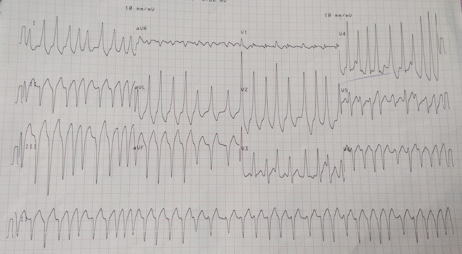 Atrial Fibrillation With Wpw