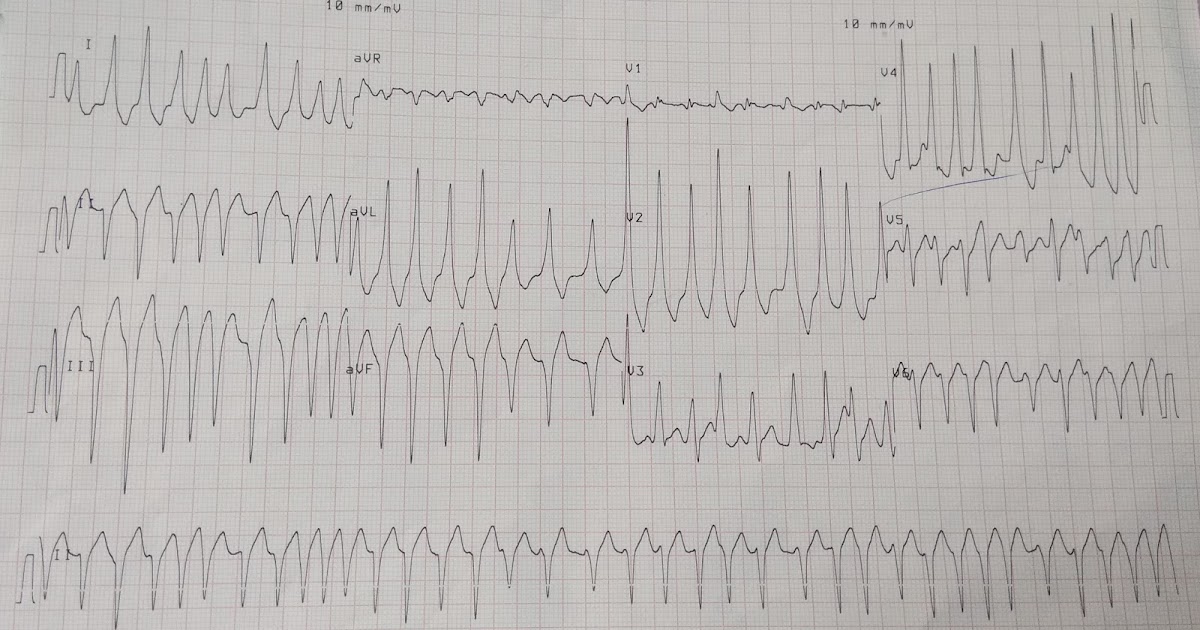 Cardiology window: WPW syndrome with atrial fibrillation