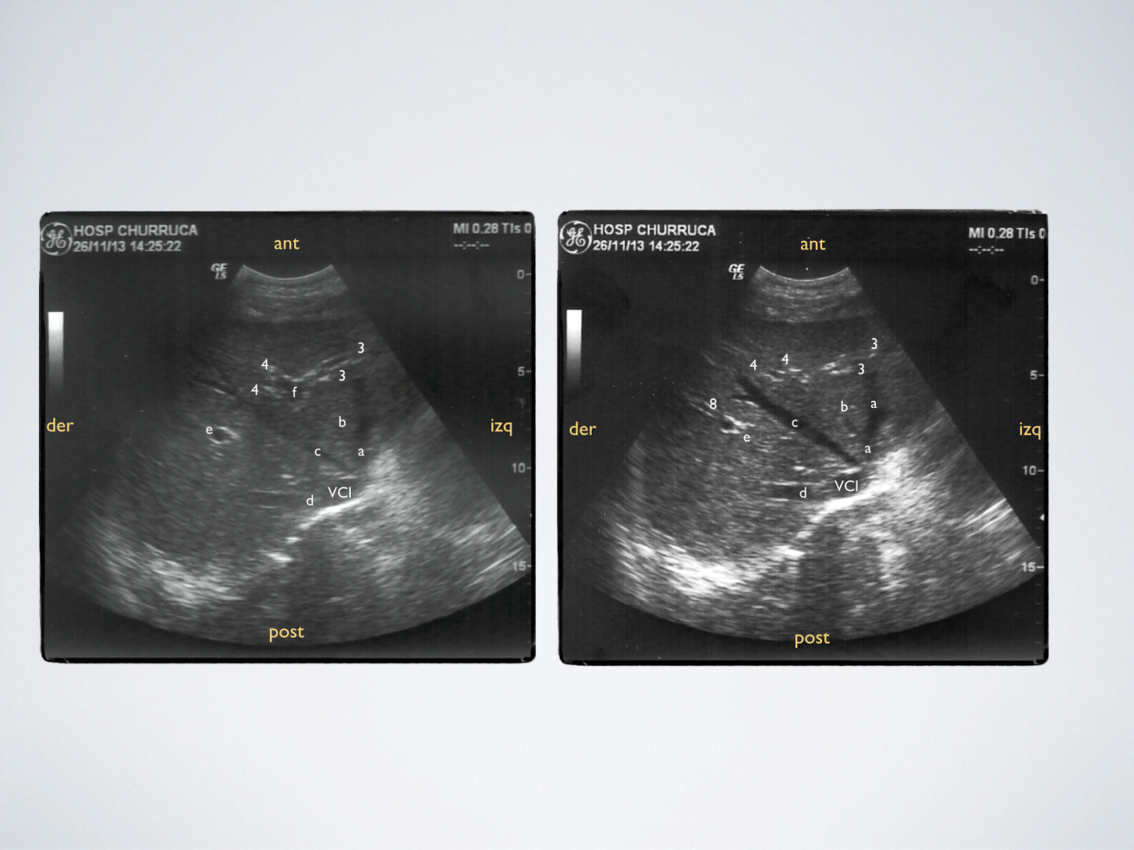 Cuadernos de Anatomía Quirúrgica: Segmentación hepática en ecografía.
