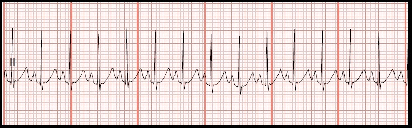 EKG Rhythm Strip Quiz 177