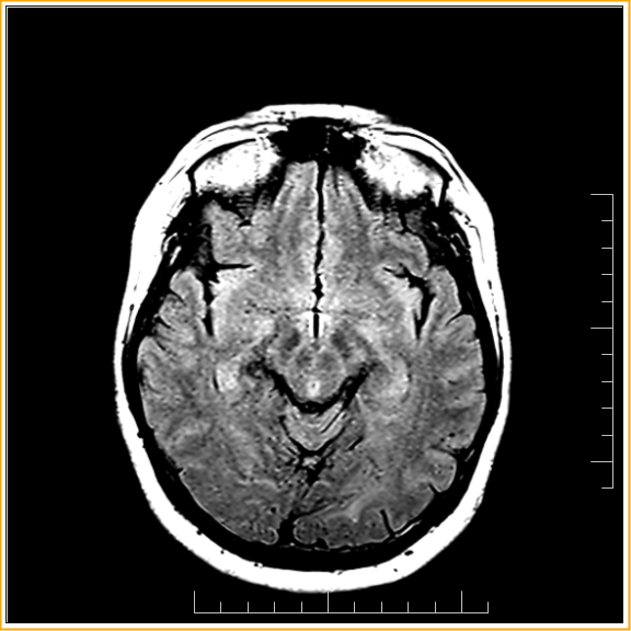 Mitochondrial protein-associated neurodegeneration (MPAN): MRI - Sumer ...