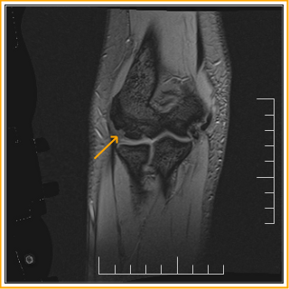 Osteochondritis of the Elbow-MRI - Sumer's Radiology Blog