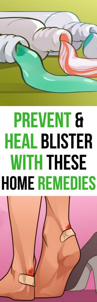 9 Home Treatments to Quickly Heal Blisters | HEALTHYLIFE