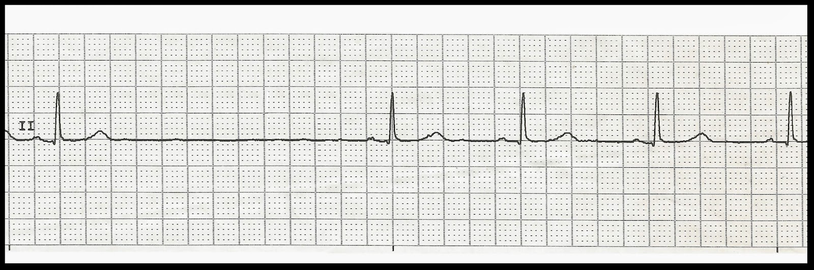 Practice EKG Strips 429