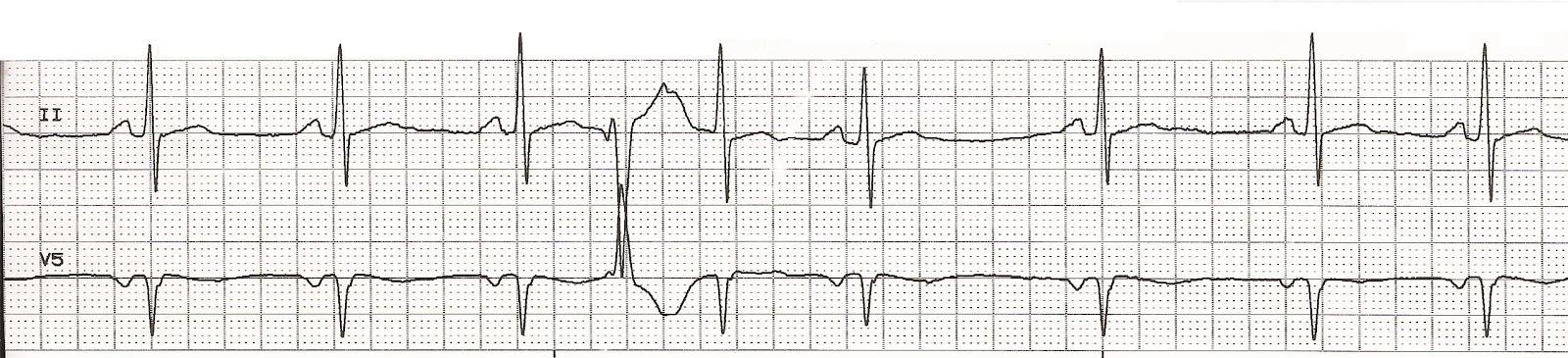 EKG Rhythm Strips 70