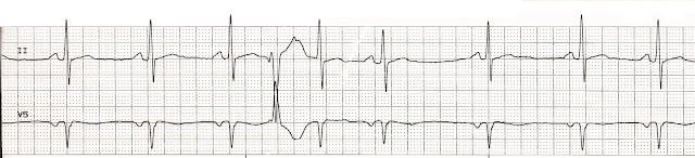 EKG Rhythm Strips 70