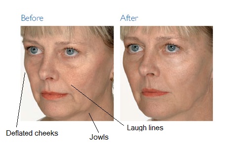 The Aesthetic Doctor's Blog: Voluma Liquid Lift - Creating The Perfect ...