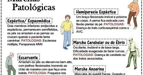 Fisiopediatria Sem Limites: TIPOS DE MARCHA