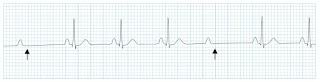 ER goldbook: EKG interpretation