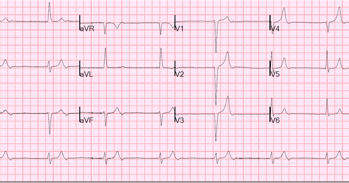 Dr. Smith's ECG Blog: Bradycardia