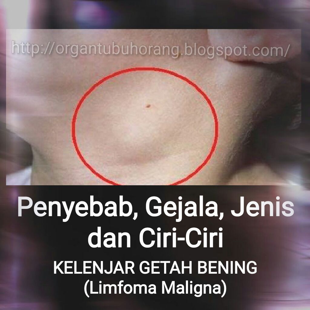 PENYEBAB, GEJALA, JENIS BESERTA CIRI-CIRINYA KANKER KELENJAR GETAH ...
