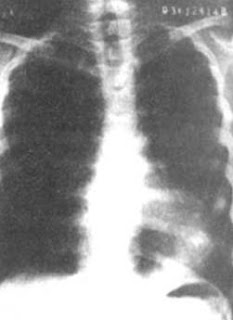 Health World Online: Pectus Excavatum-Funnel chest