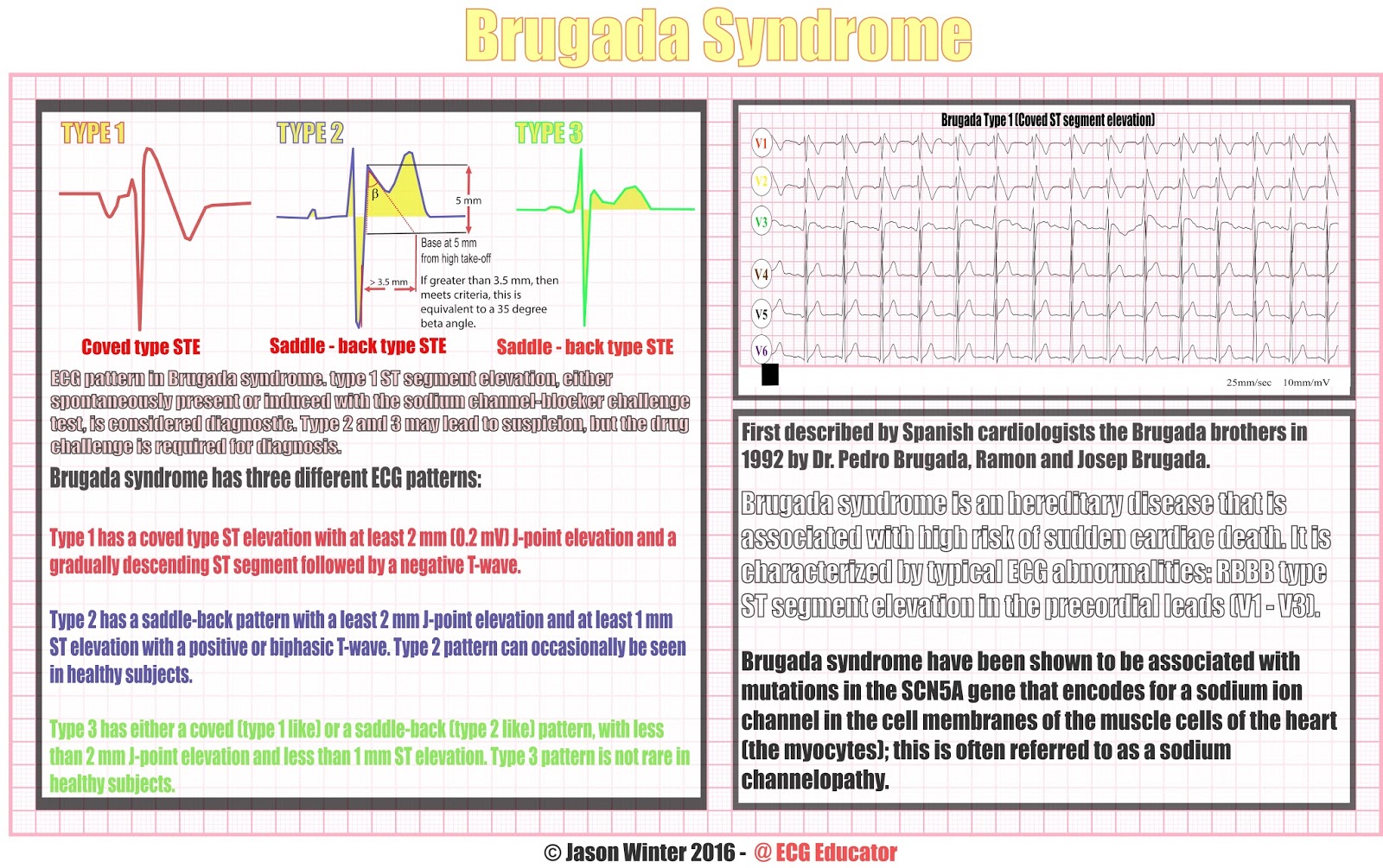 ECG Educator Blog : Brugada Syndrome