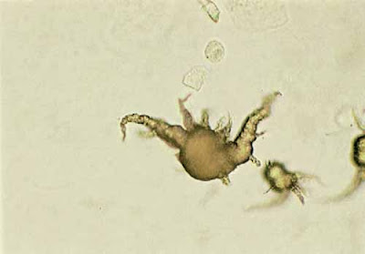 Atlas of Crystals found in alkaline urine | Free Medical Atlas