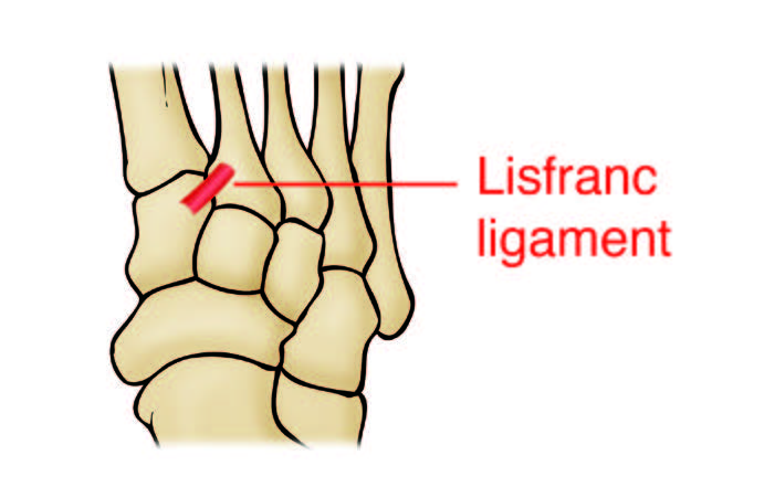 Lisfranc Injuries | An Uncommon Midfoot Injury