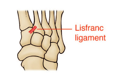 Lisfranc Injuries | An Uncommon Midfoot Injury