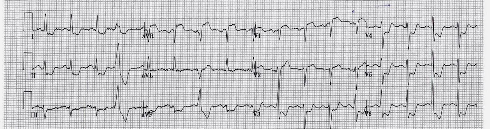 Dr. Smith's ECG Blog: ST Elevation in Lead aVR, with diffuse ST ...