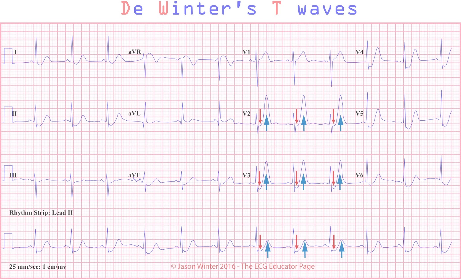 ECG Educator Blog : De Winters T waves