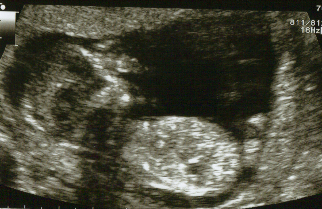 Baby Steps in Walthamstow: Week 13: the first scan