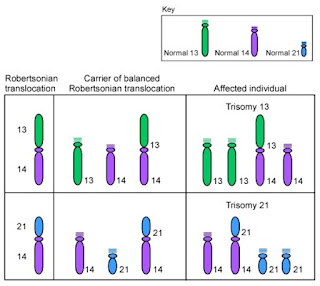DOWN SYNDROME, TRISOMY 21, TYPES, CAUSES AND PHYSICAL CHARACTERISTICS ...