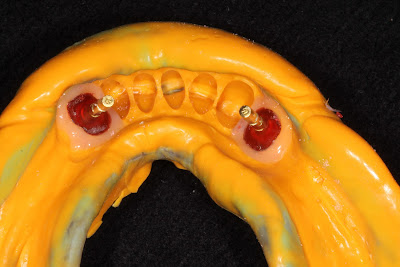 Boise Idaho Prosthodontics: Semi-Precision attachment RPD - 3 different ...