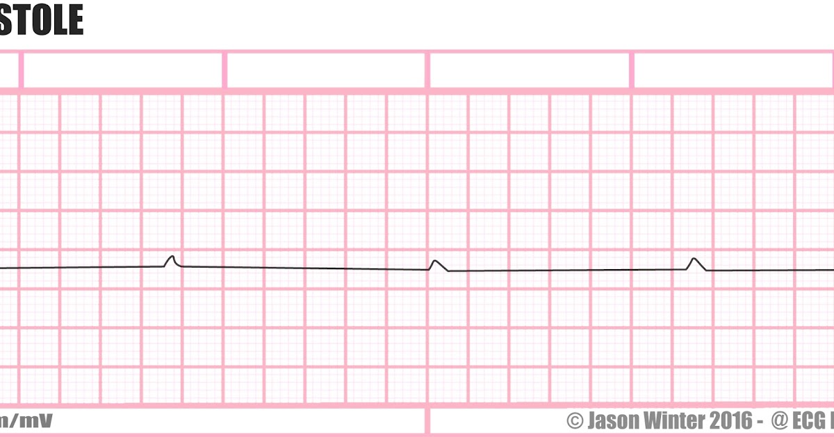ECG Educator Blog : P Wave Asystole