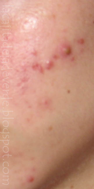 La cajita de Jade verde: Diario de una piel con acné-rosácea (III ...