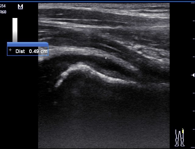 EcoCyl-Msk: Sinovitis transitoria de cadera