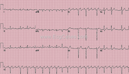 Stenosis: Ecg Mitral Stenosis