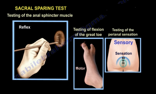 Dr. Nabil Ebraheim's Blogspot: Bulbocavernosus Reflex and Spinal Shock