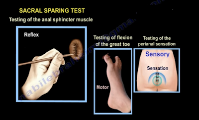 Dr. Nabil Ebraheim's Blogspot: Bulbocavernosus Reflex and Spinal Shock