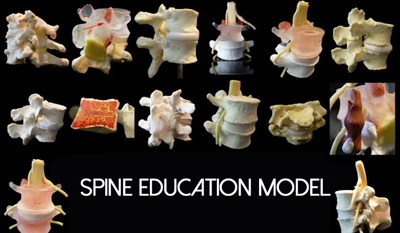 Spine Education Model - Dynamic Disc Designs: Anatomical Spine ...