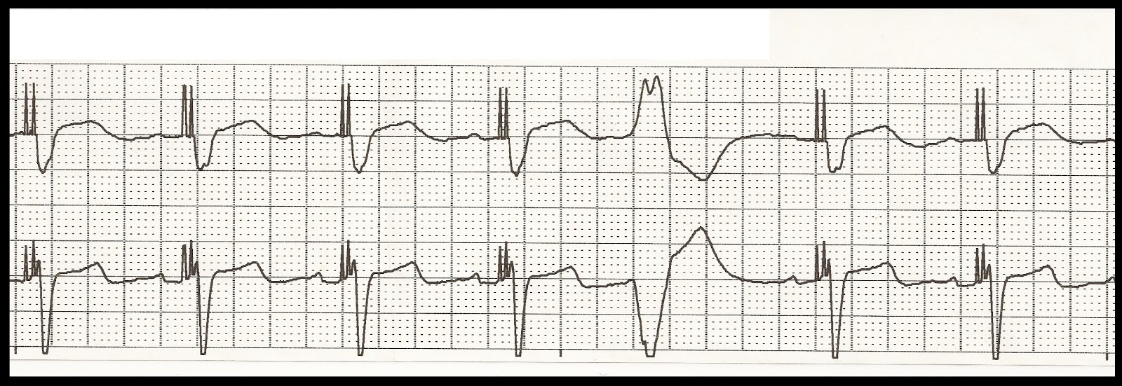 Basic ECG Rhythm Test 03
