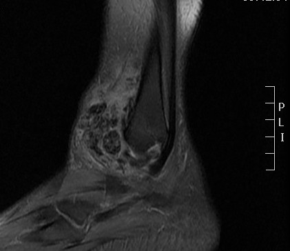 Pigmented Villonodular Synovitis Ankle - Sumer's Radiology Blog