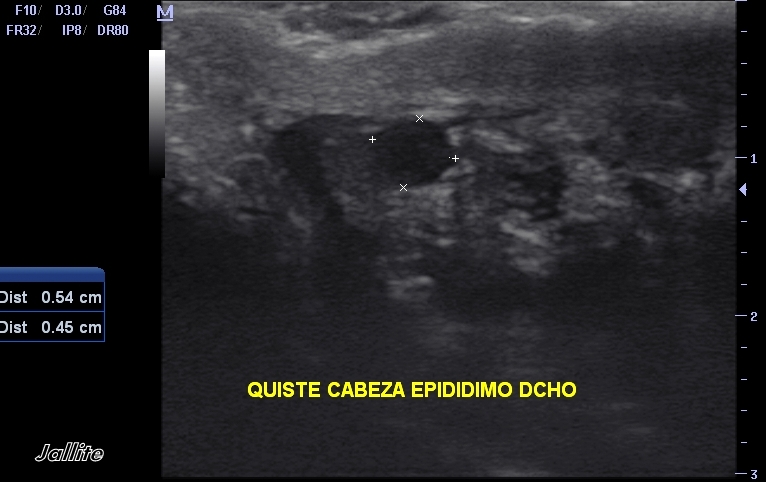 Engrosamiento Escrotal post Absceso