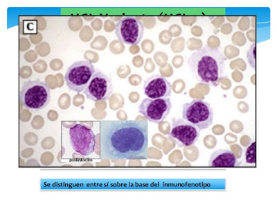 Hematología Fichas: Leucemia de Células Pilosas (Tricoleucemia)