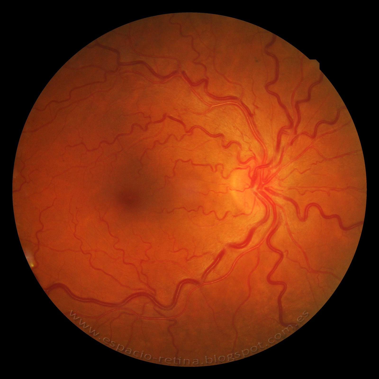 ESPACIO RETINA: Retinopatía HTA