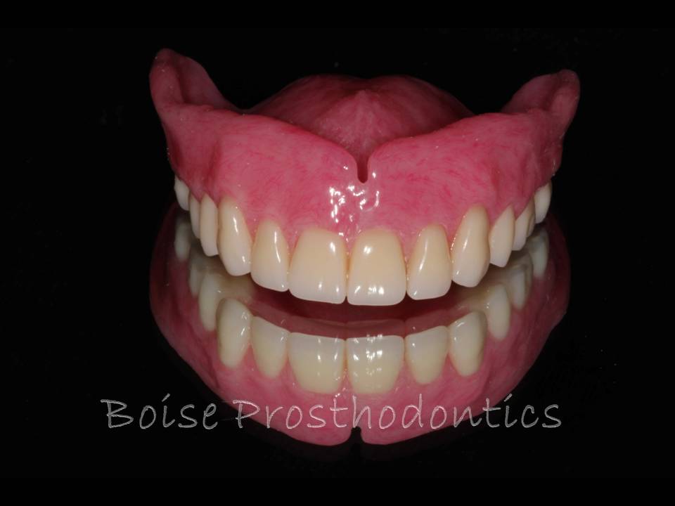 Boise Idaho Prosthodontics: Picture Sequence of Maxillary Complete ...