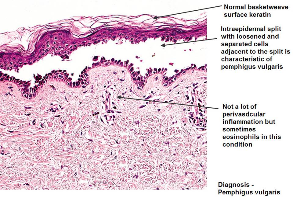 Consultations in Dermatology: Blisters and Crusts- Pemphigus