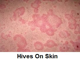 Hives Causes, Symptoms, Diagnosis And Treatment | Health And Beauty