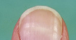 Ridges on my fingernails - Awesome Nail