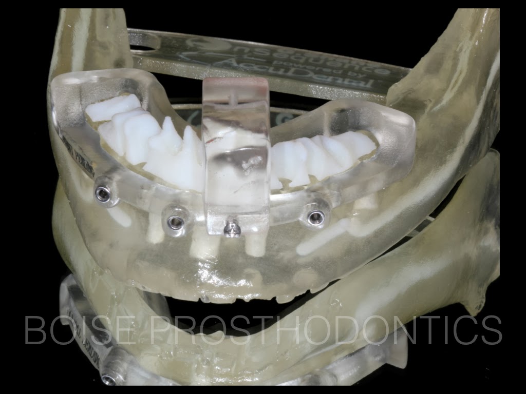 Boise Idaho Prosthodontics: Immediate Load Implant Prosthesis - Hybrid