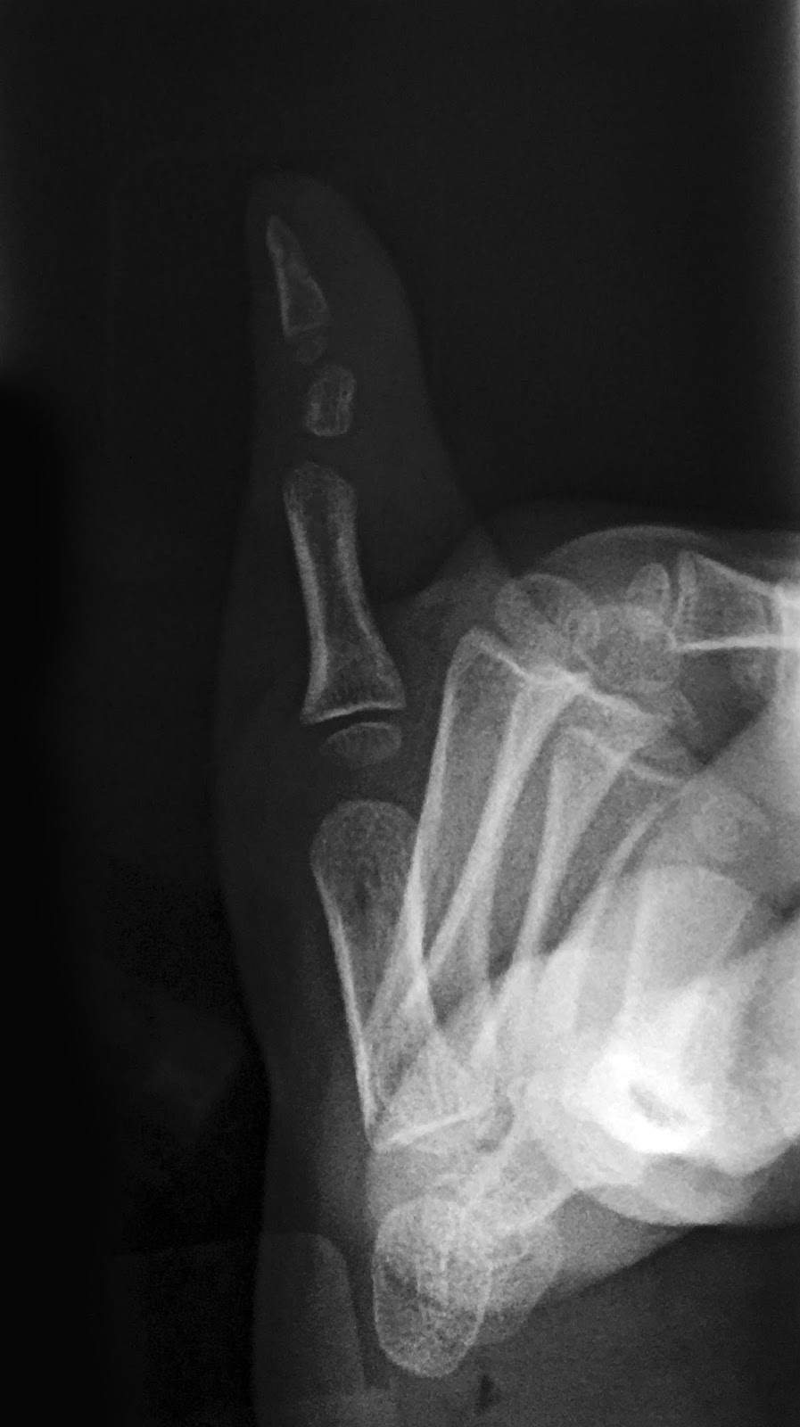 Thumb Deformity | Congenital Hand and Arm Differences | Washington ...