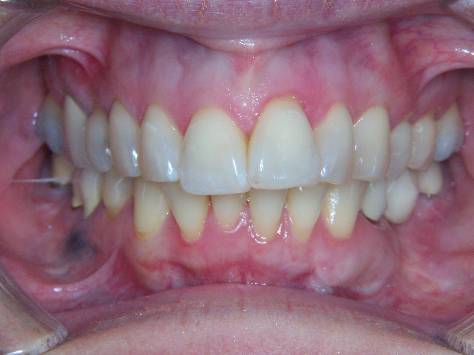 Truman Orthodontics: Narrow Smile