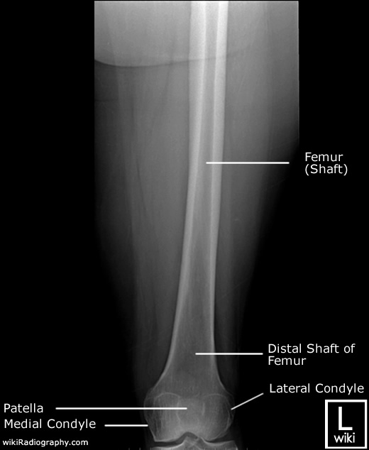 ANATOMI RADIOGRAFI FEMUR - Radiografer
