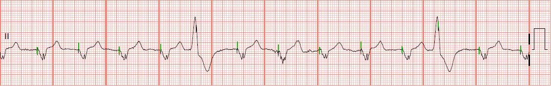 EKG Rhythm Strips 25: Ectopic beats